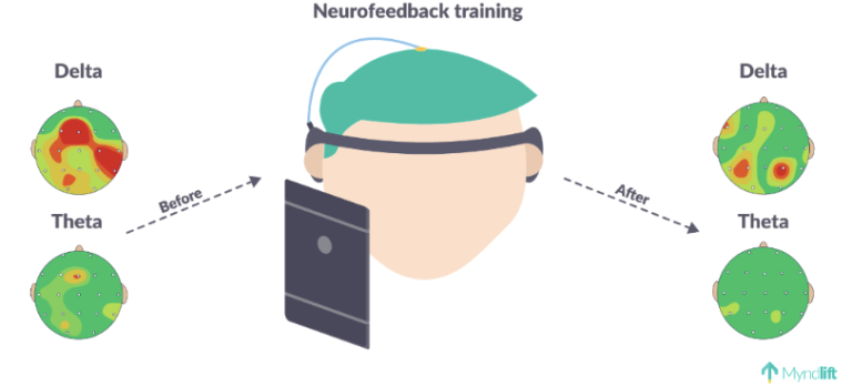 Neurofeedback | Dairek Morgan Therapy